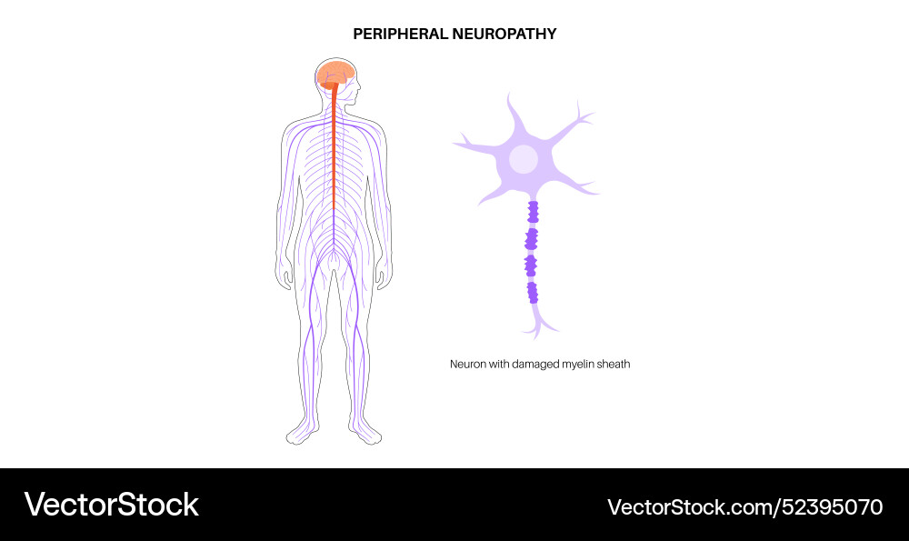 Peripheral neuropathy medical poster Royalty Free Vector