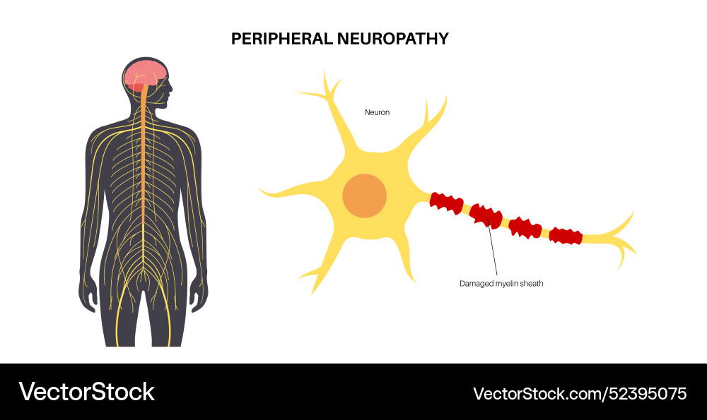 Peripheral neuropathy medical poster Royalty Free Vector