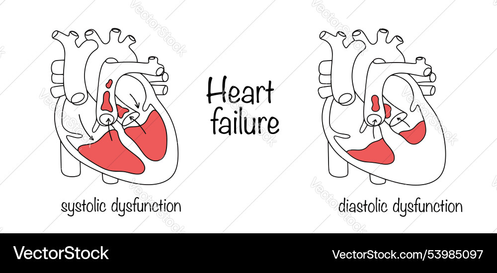 Heart failure Royalty Free Vector Image - VectorStock