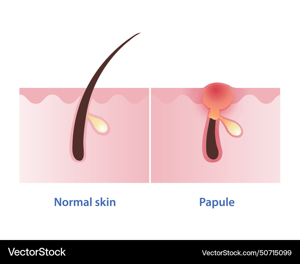 Papule type of inflammatory acne Royalty Free Vector Image