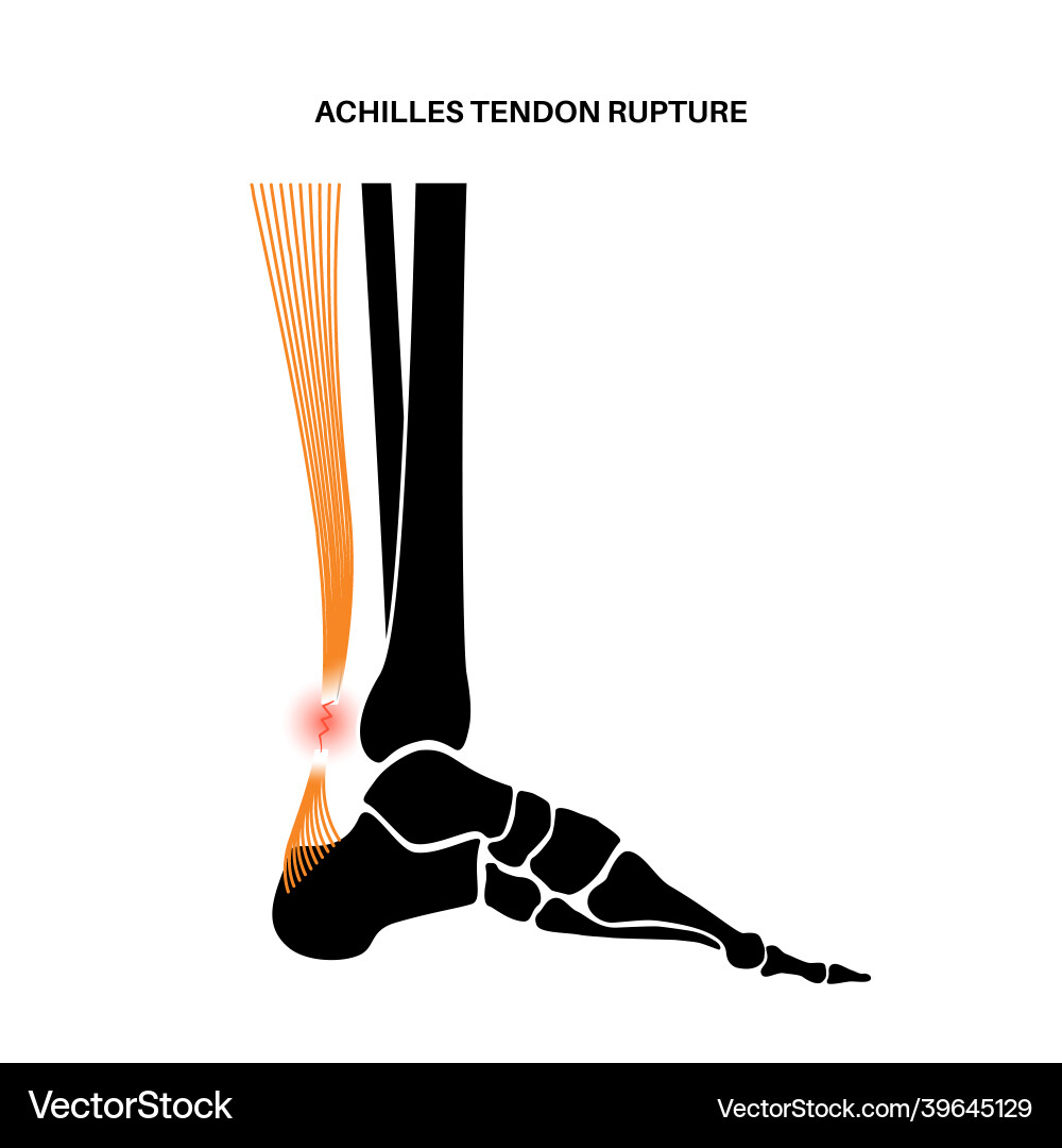 Achilles Tendon Rupture Anatomy Royalty Free Vector Image
