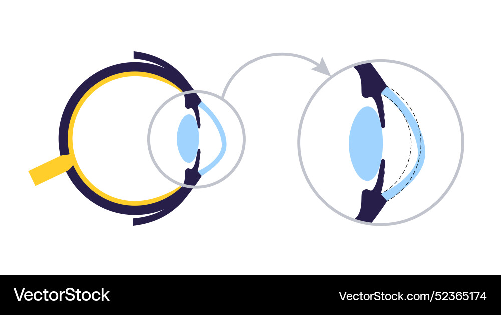 Cataract eye disease Royalty Free Vector Image