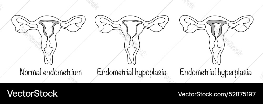 Endometrial hypoplasia hyperplasia Royalty Free Vector Image