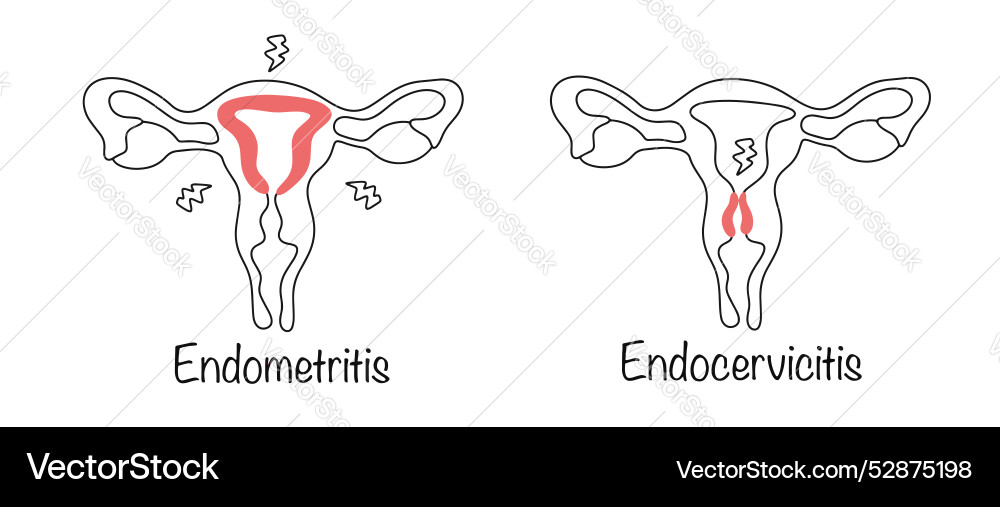 Endometritis endocervicitis Royalty Free Vector Image