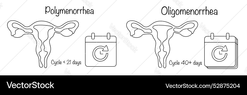 Polymenorrhea oligomenorrhea Royalty Free Vector Image