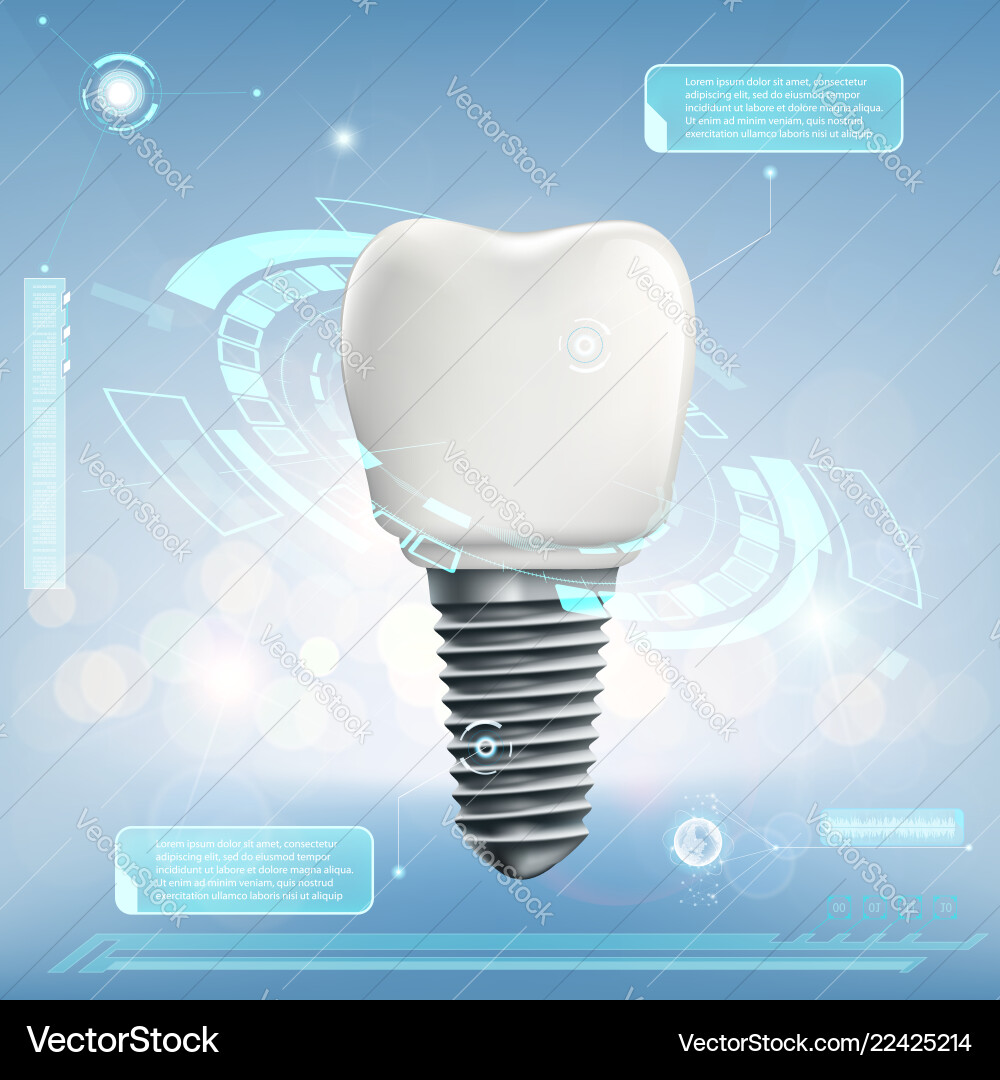 Human dental implant Royalty Free Vector Image