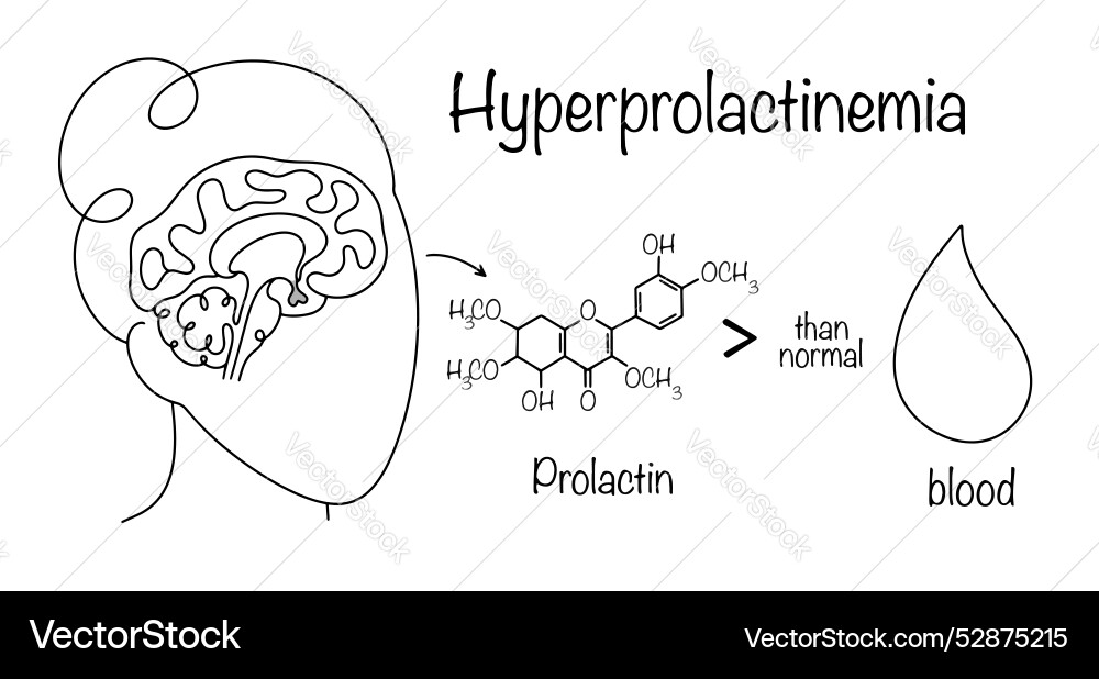 Hyperprolactinemia Royalty Free Vector Image - VectorStock