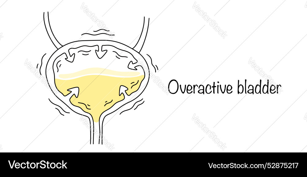 Bladder hyperactivity Royalty Free Vector Image