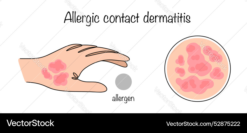 Allergic contact dermatitis Royalty Free Vector Image
