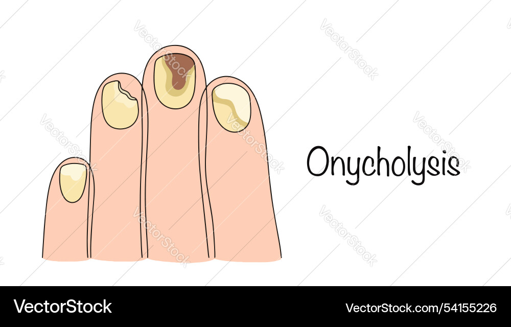 Onycholysis Royalty Free Vector Image - VectorStock
