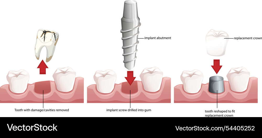 Step-by-step guide to dental implant process Vector Image