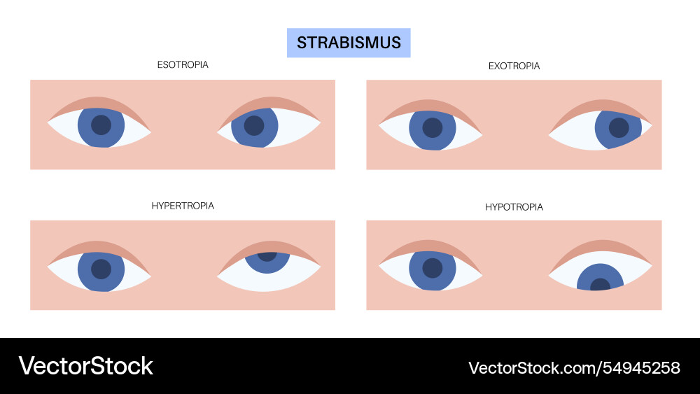 Strabismus eye disease Royalty Free Vector Image