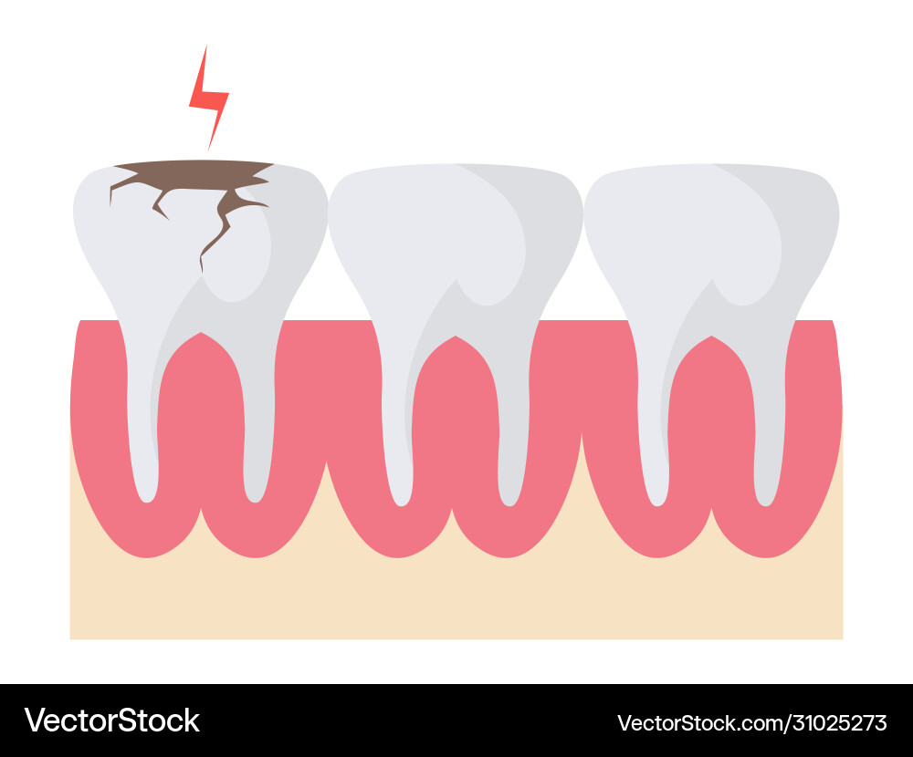 Tooth decay in mouth schematic cartoon on white Vector Image
