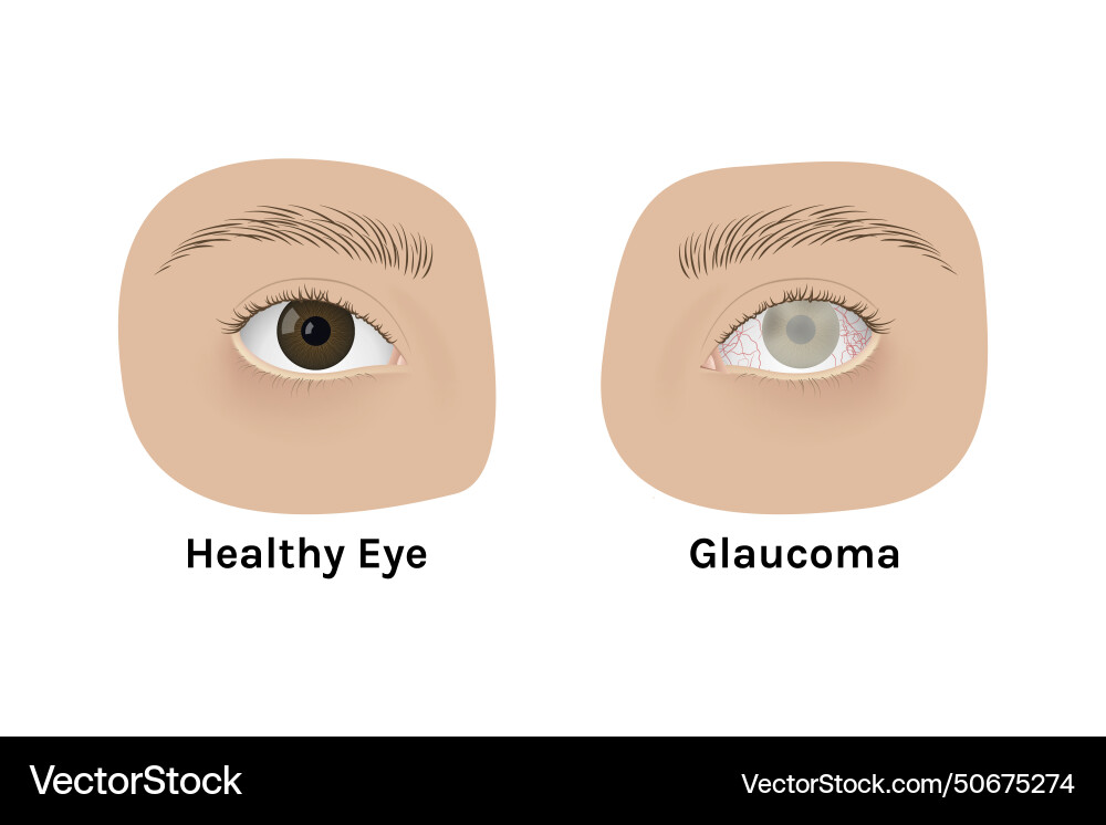 Realistic human healthy eye and with glaucoma Vector Image