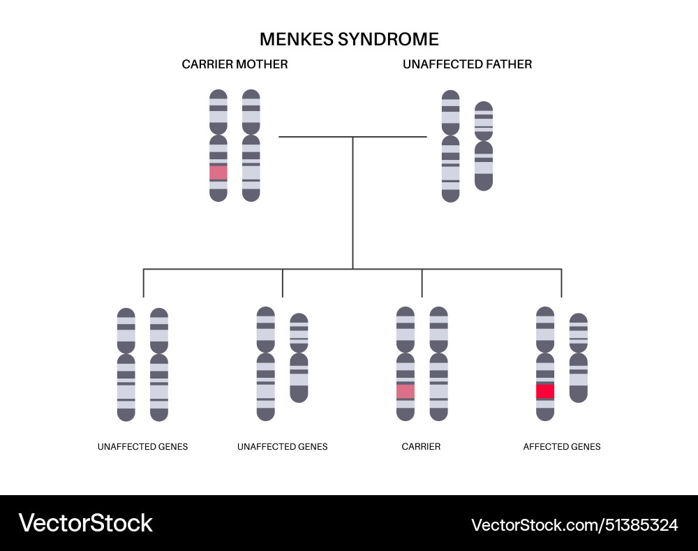 Menkes syndrome poster Royalty Free Vector Image