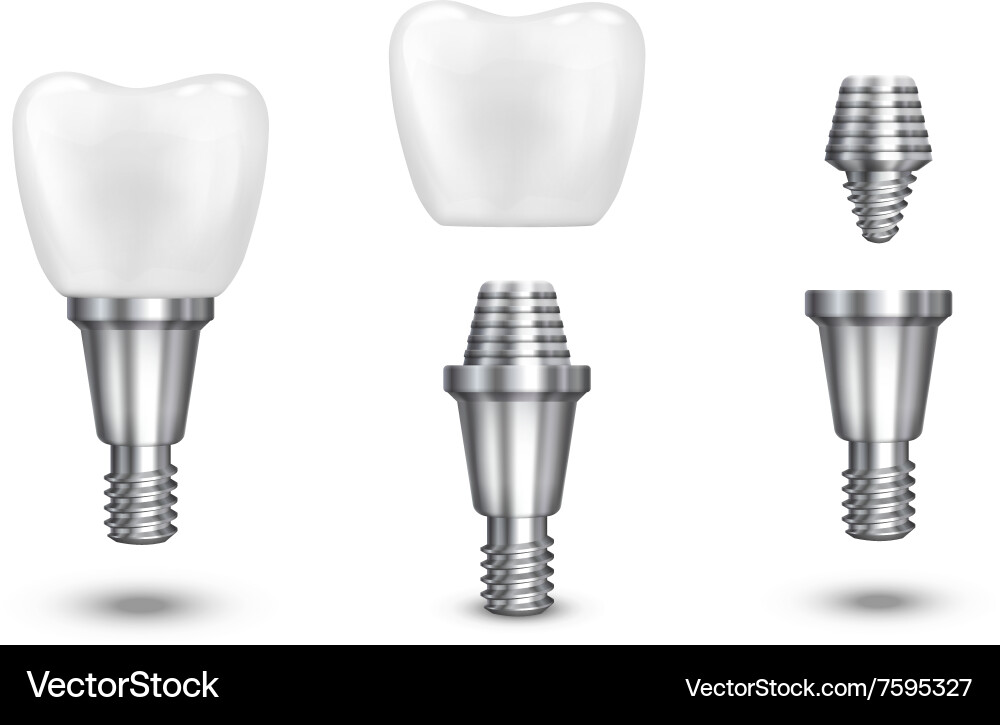 Tooth implant Royalty Free Vector Image - VectorStock