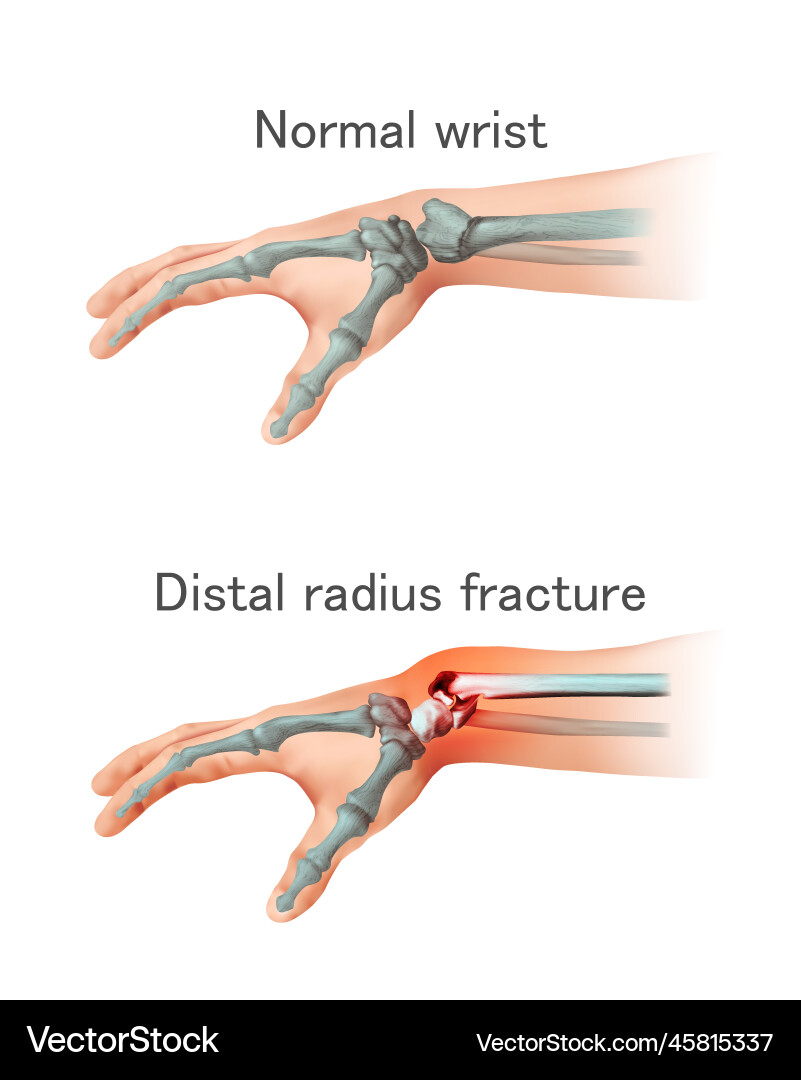 Wrist bone injury Royalty Free Vector Image - VectorStock