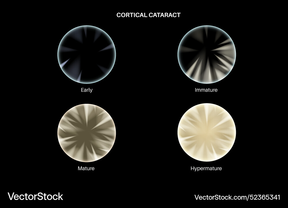 Cataract eye disease Royalty Free Vector Image