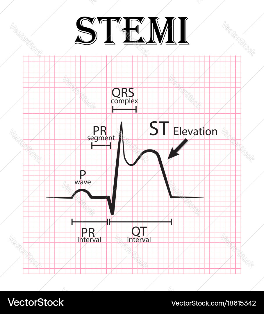 Ecg of st elevation myocardial infarction stemi Vector Image Ecg of st elevation myocardial infarction stemi Vector Image