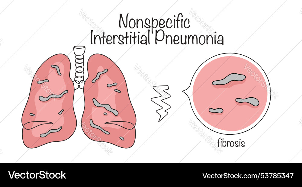 Nonspecific interstitial pneumonia Royalty Free Vector Image