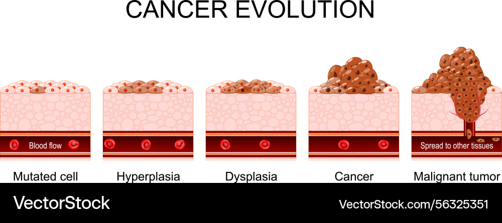 Cancer evolution from hyperplasia and mutated Vector Image