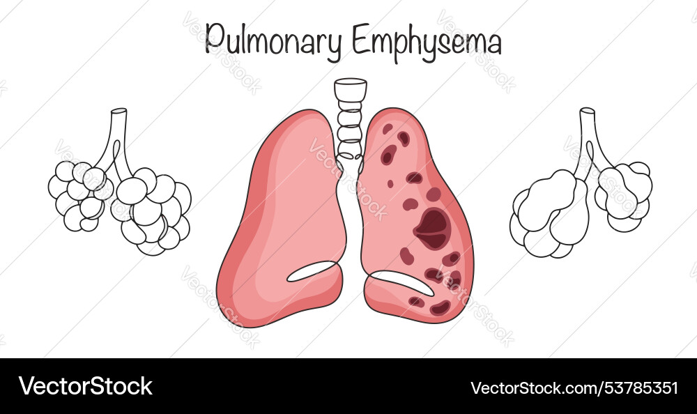 Pulmonary emphysema Royalty Free Vector Image - VectorStock