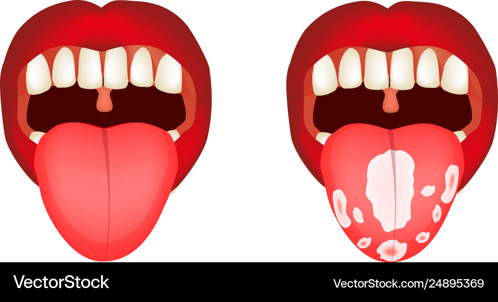 Candidiasis tongue thrush inflammation – Royalty-Free Vector | VectorStock