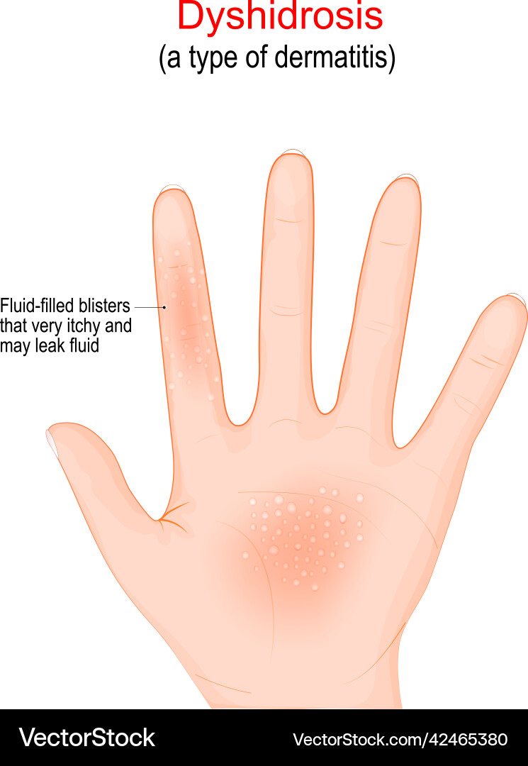 Dyshidrosis type of dermatitis with itchy Vector Image