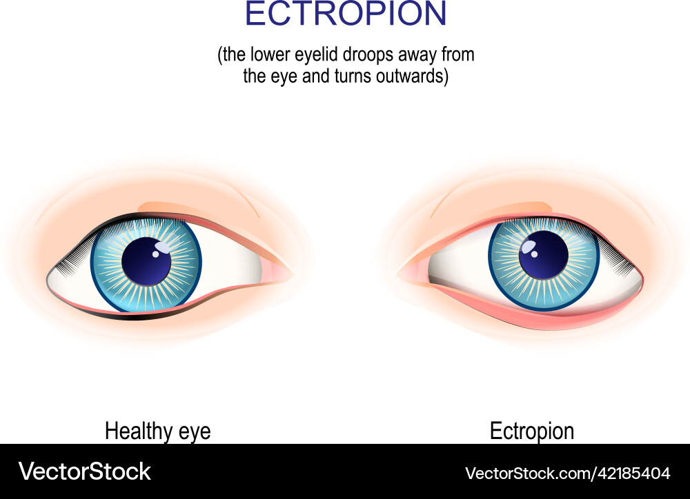 Ectropion the lower eyelid droops away from Vector Image