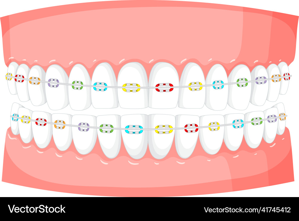 Dental Braces Model - White Background Royalty Free Vector