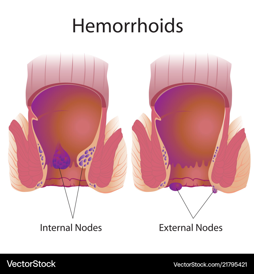 Hemorrhoids Royalty Free Vector Image - VectorStock
