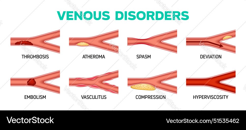 Vein disease venous disorders infographics Vector Image