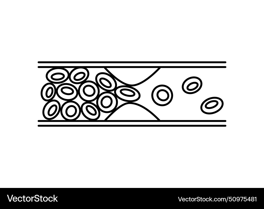 Deep vein thrombosis dvt artery and disease Vector Image