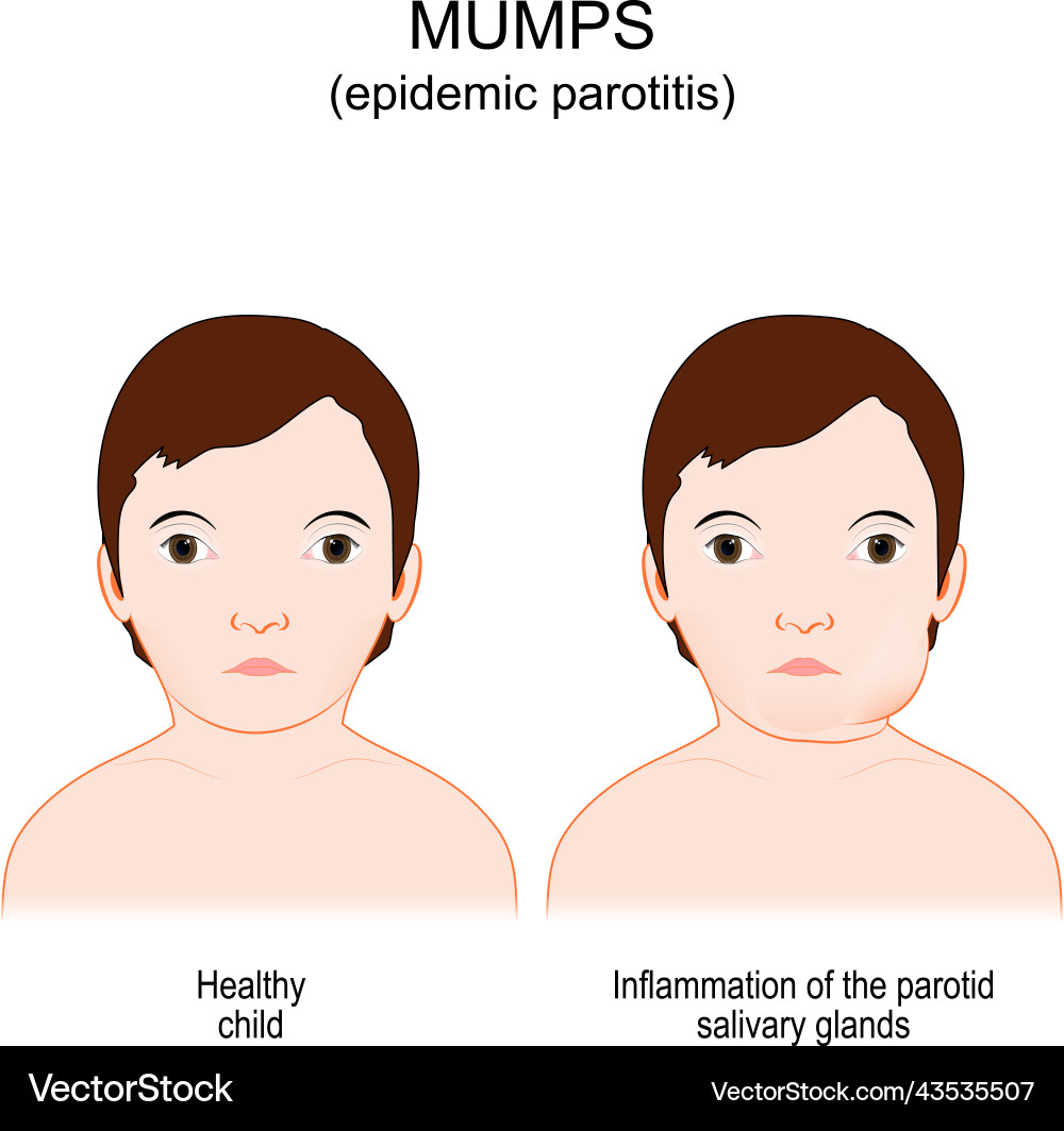 Mumps epidemic parotitis viral disease Royalty Free Vector
