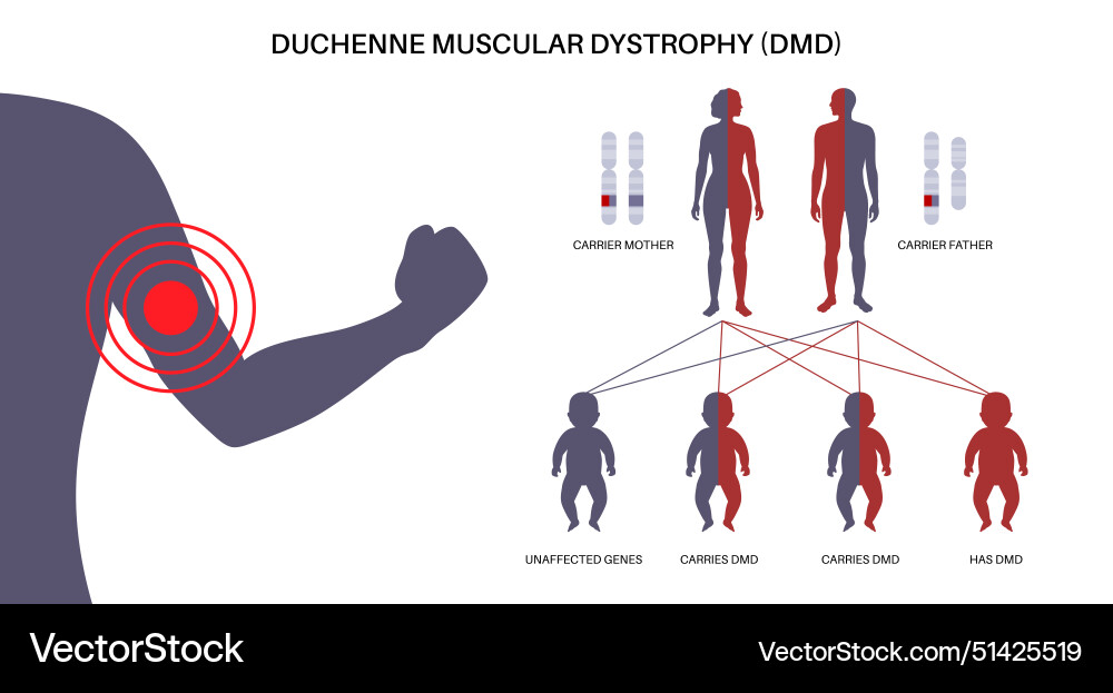 Duchenne muscular dystrophy Royalty Free Vector Image