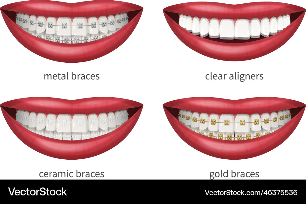 Teeth braces set Royalty Free Vector Image - VectorStock