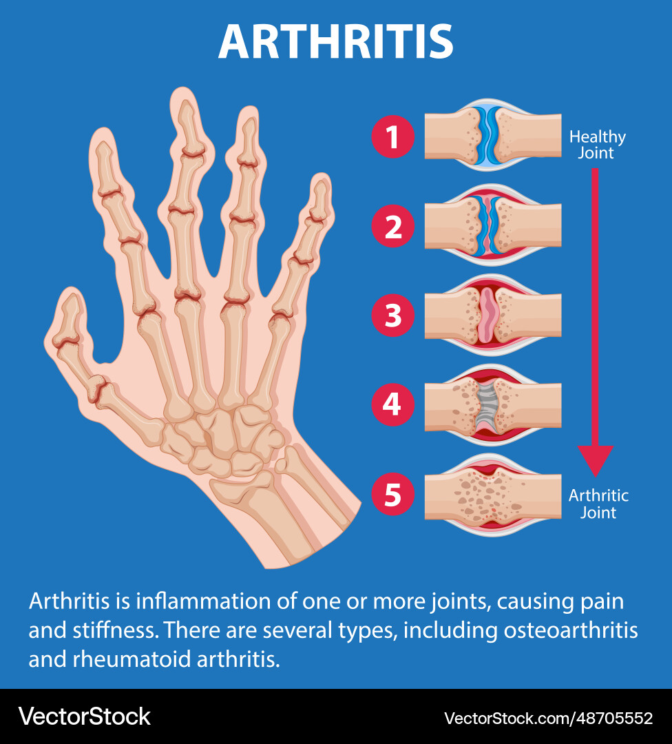 Science education human anatomy and arthritis Vector Image