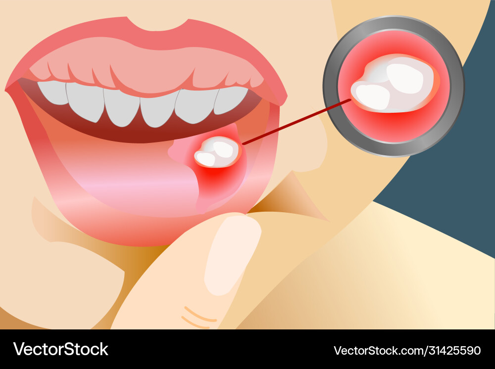 Aphtha with magnifying glass on lip close up Vector Image