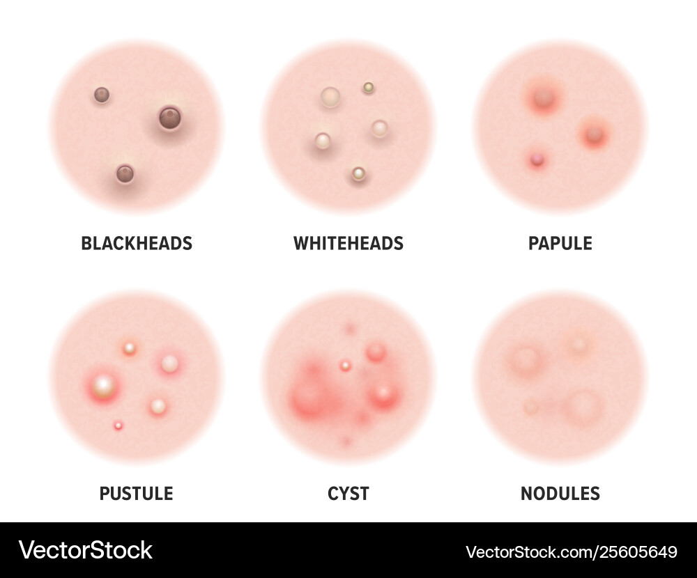 Skin acne types diagram disease pimples Royalty Free Vector
