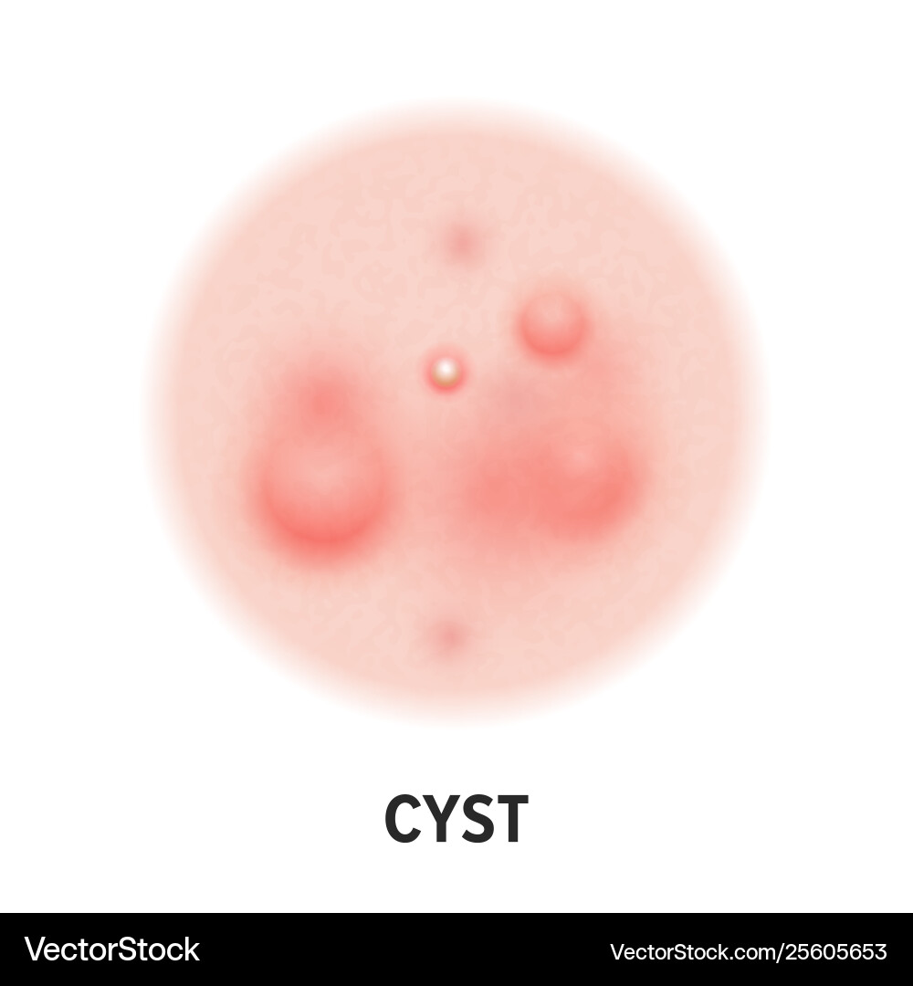 Cyst skin acne type icon disease Royalty Free Vector Image
