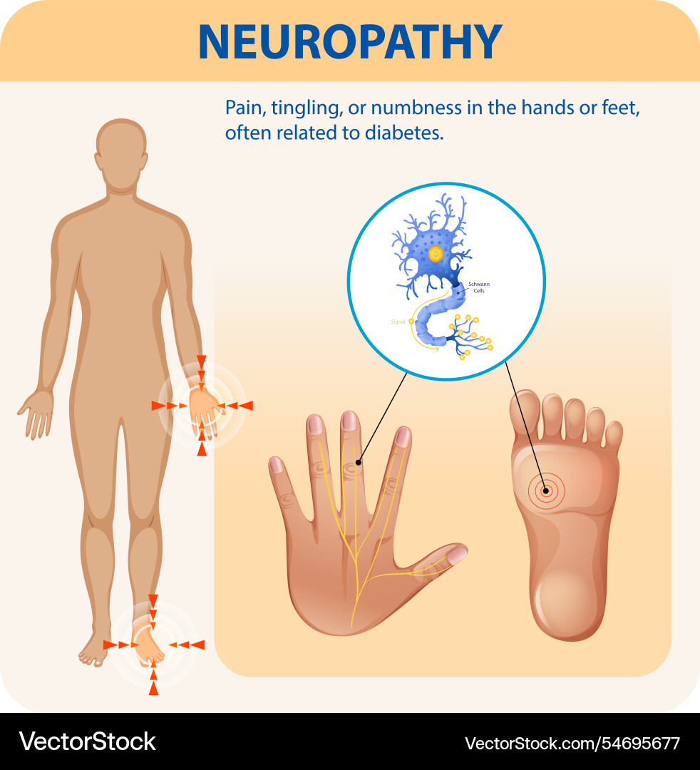 Neuropathy affecting hands and feet Royalty Free Vector