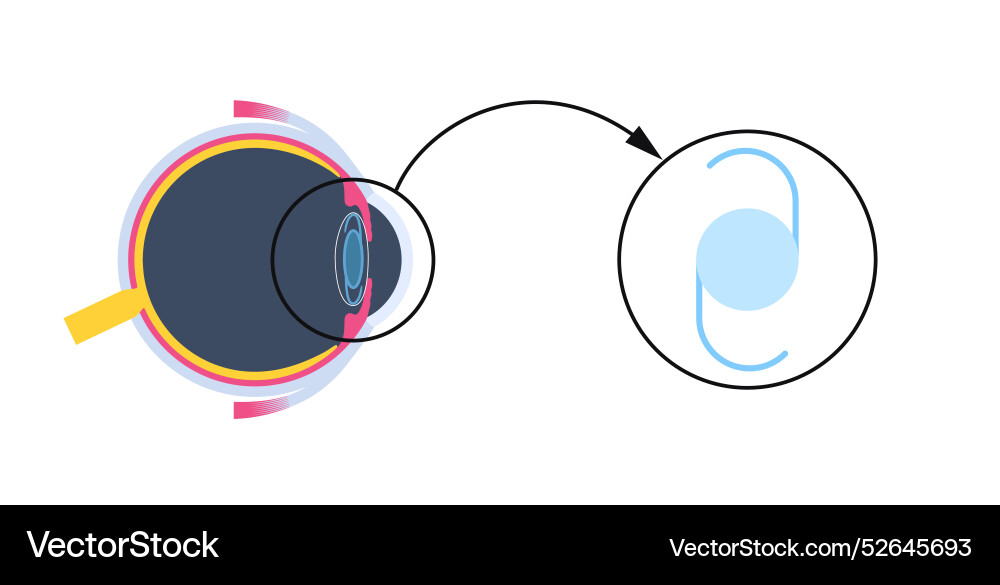 Intraocular lens poster Royalty Free Vector Image