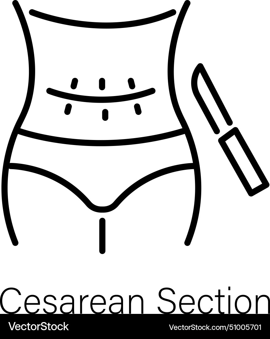 Cesarean section Royalty Free Vector Image - VectorStock