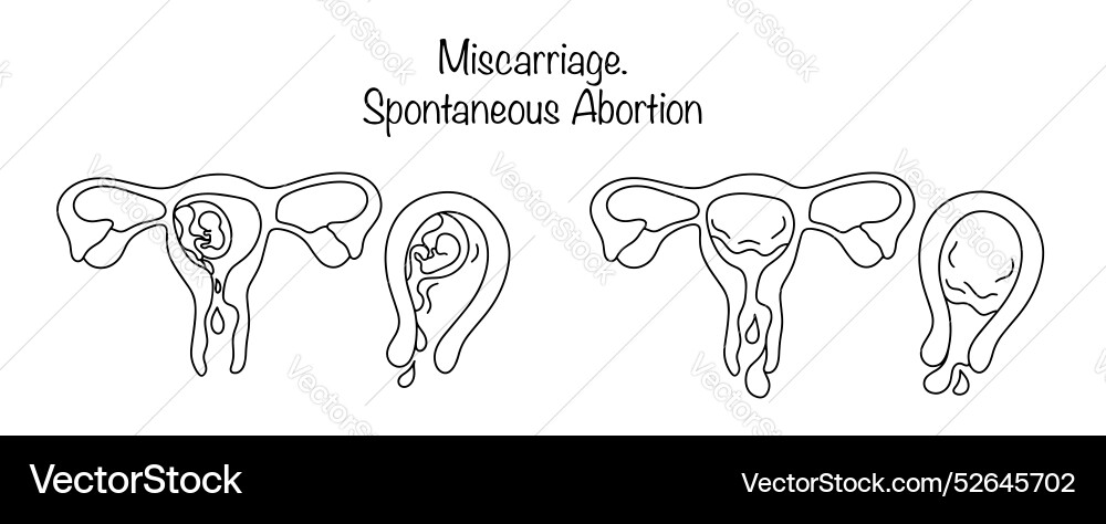 Miscarriage Royalty Free Vector Image - VectorStock