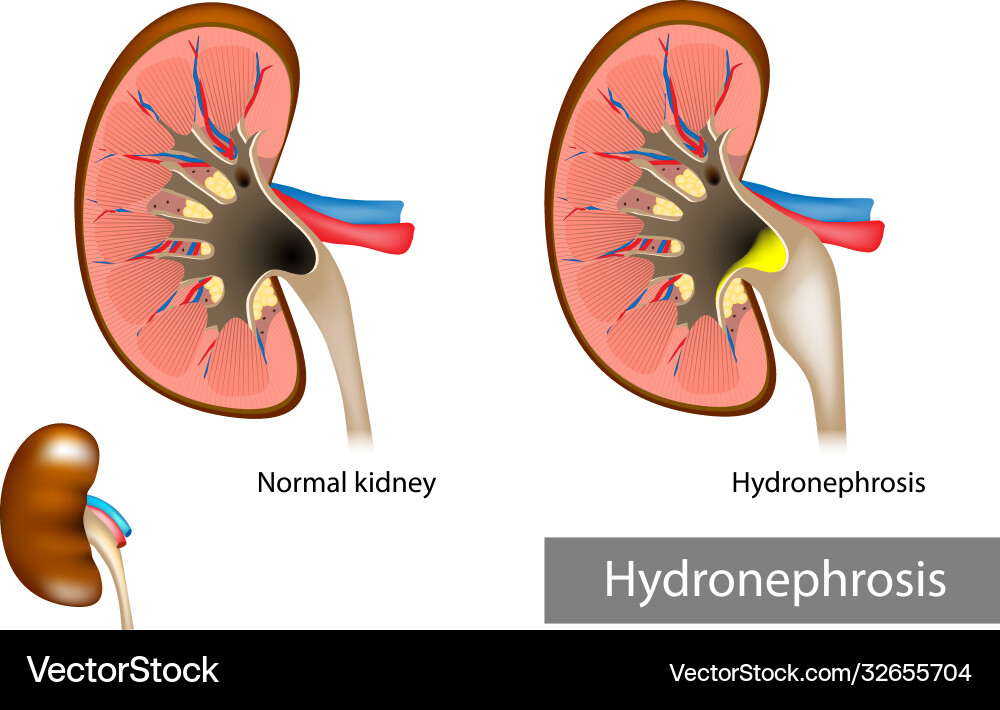 Hydronephrosis urinary tract dilation Royalty Free Vector