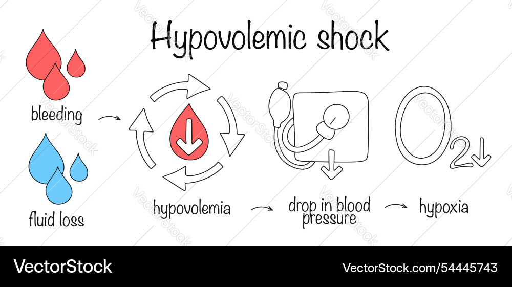 Hypovolemic shock Royalty Free Vector Image - VectorStock