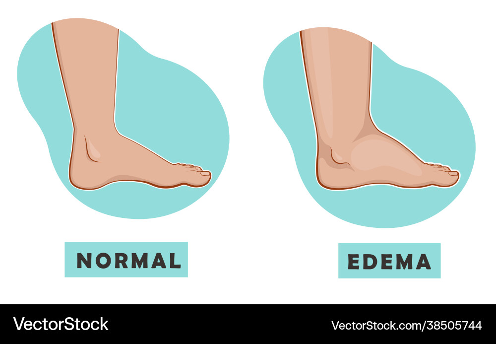 Swollen Foot and Normal Foot Comparison Royalty Free Vector