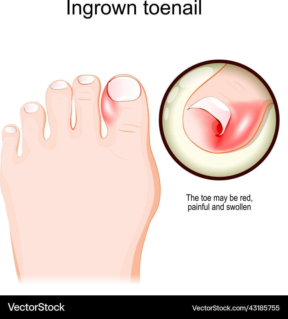 Ingrown toenail human foot Royalty Free Vector Image