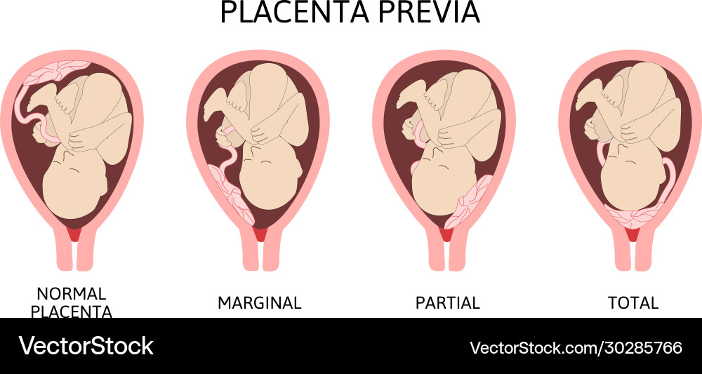 Different placental locations during pregnancy Vector Image