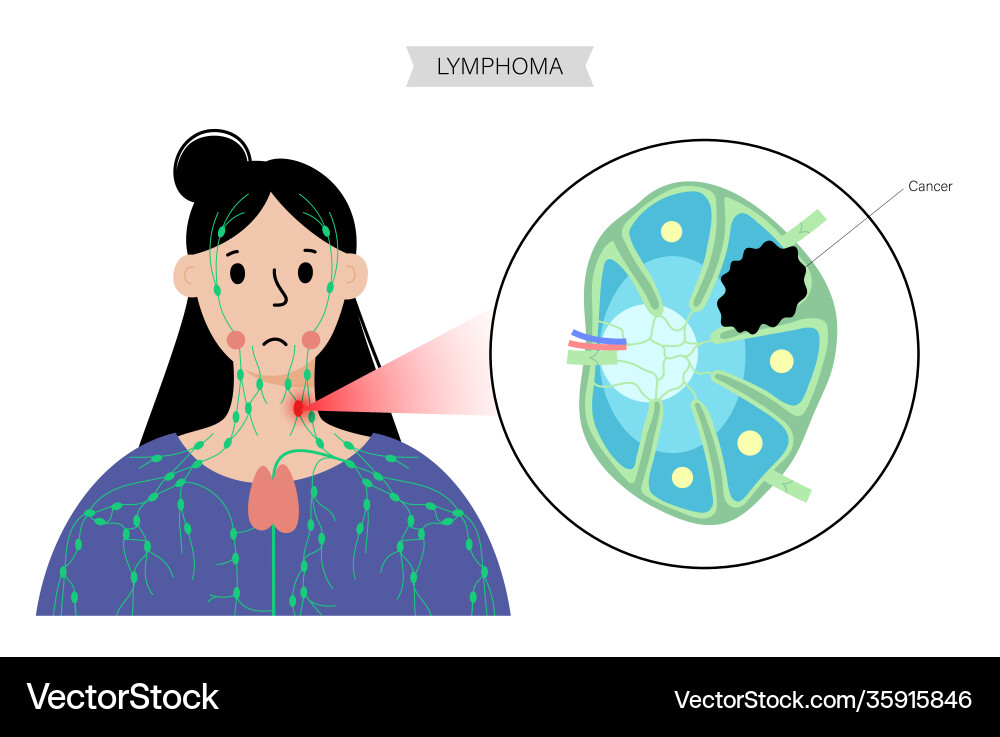 Lymphoma cancer concept Royalty Free Vector Image